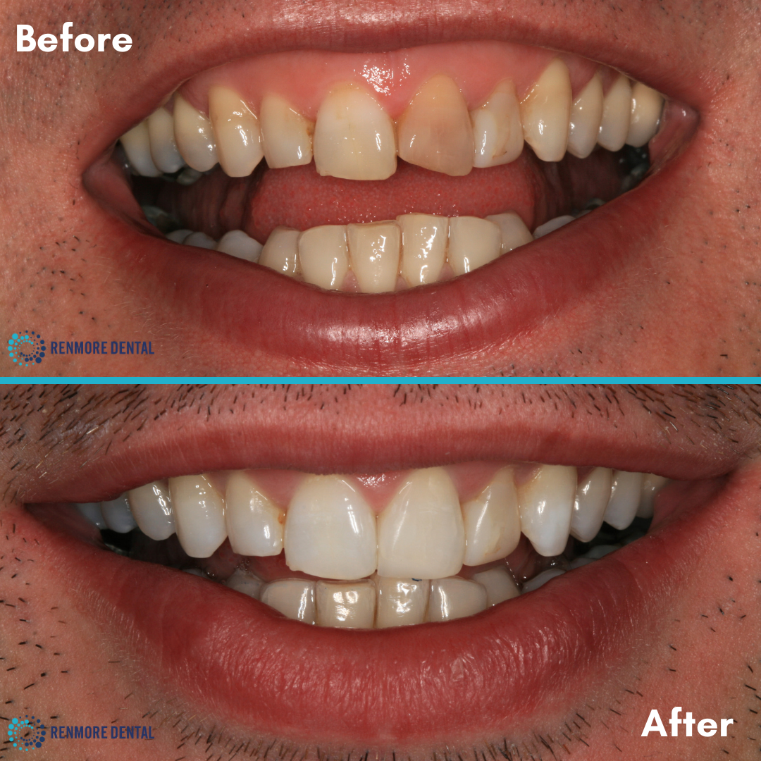 Non-Vital Tooth Whitening Explained - Renmore Dental | Galway Dentist ...