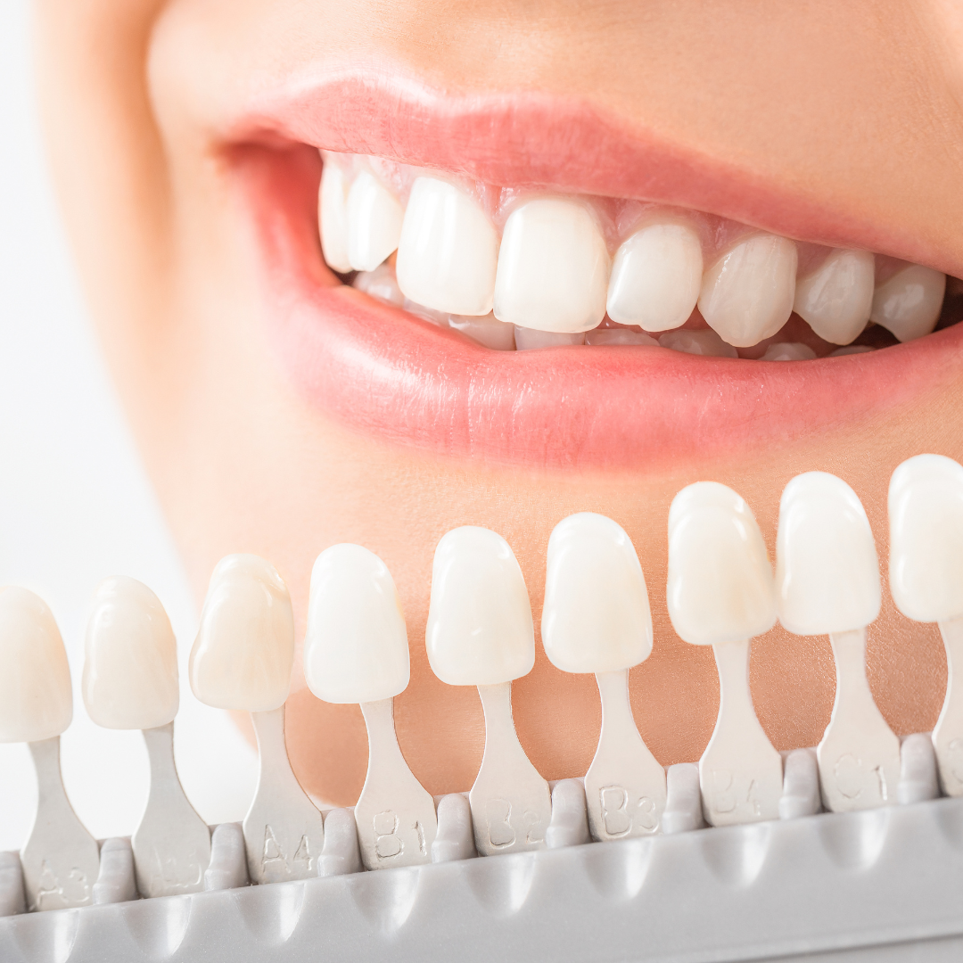 Non-Vital Tooth Whitening Explained - Renmore Dental | Galway Dentist ...