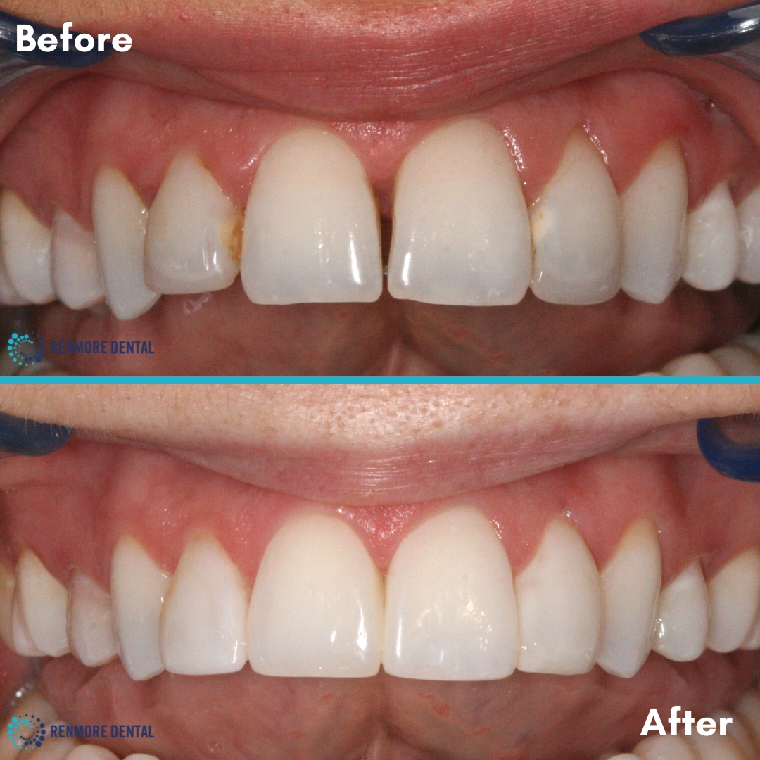 What is Composite Bonding? - Renmore Dental | Galway Dentist, Ireland