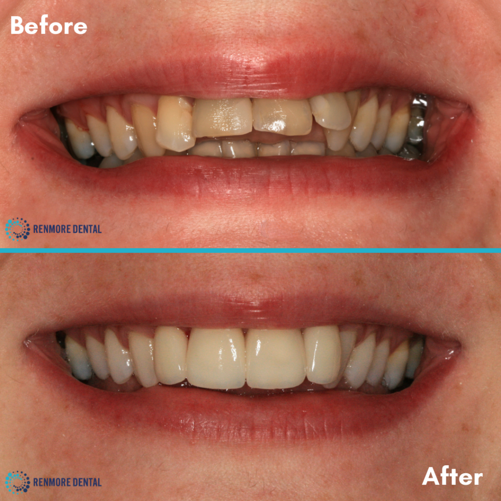 What is a Dental Crown? Dental Crowns Explained - Renmore Dental ...
