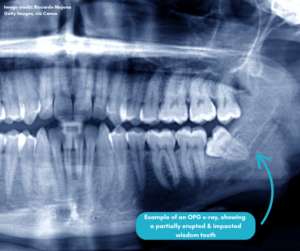 Why do wisdom teeth cause pain? Wisdom Tooth FAQ - Renmore Dental ...